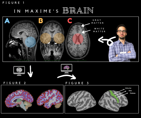 Maxime’s brain – Speechneurolab