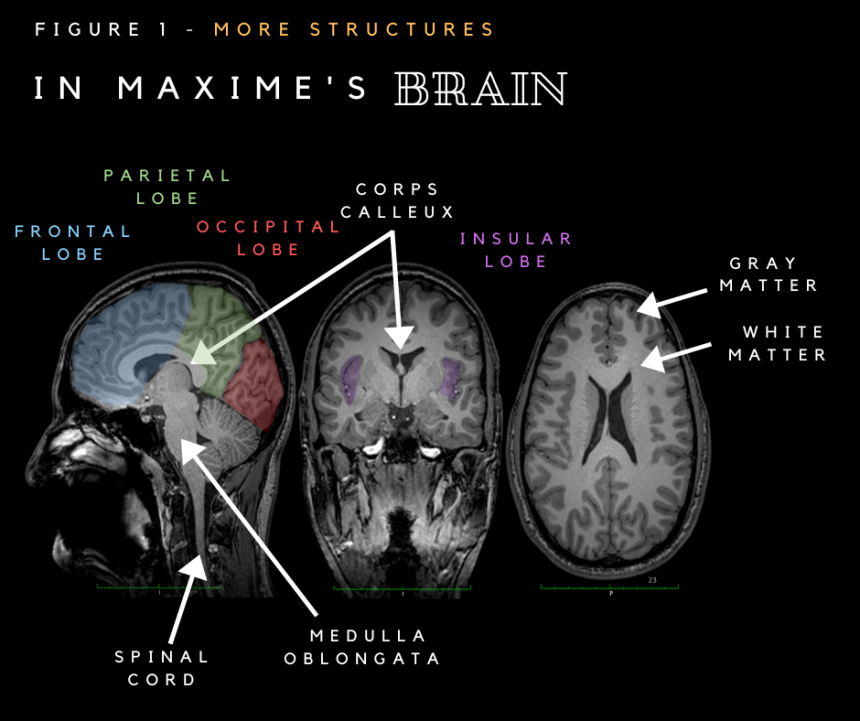 Maxime’s brain – Speechneurolab