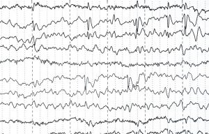 Electroencephalography (EEG) – Speechneurolab