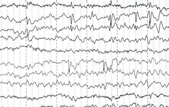 L’électroencéphalographie (EEG) – Speechneurolab