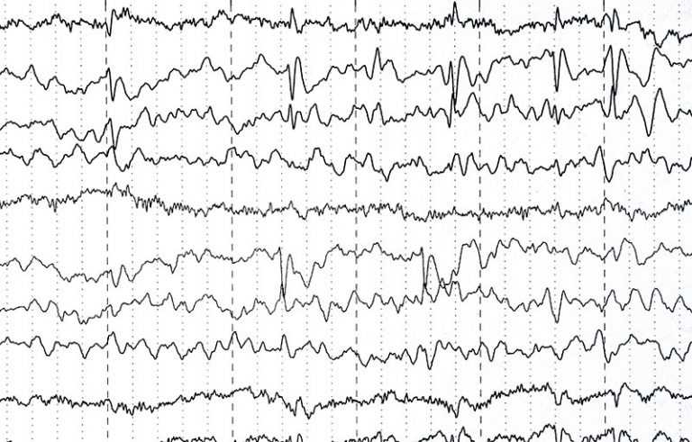 L’électroencéphalographie (EEG) – Speechneurolab
