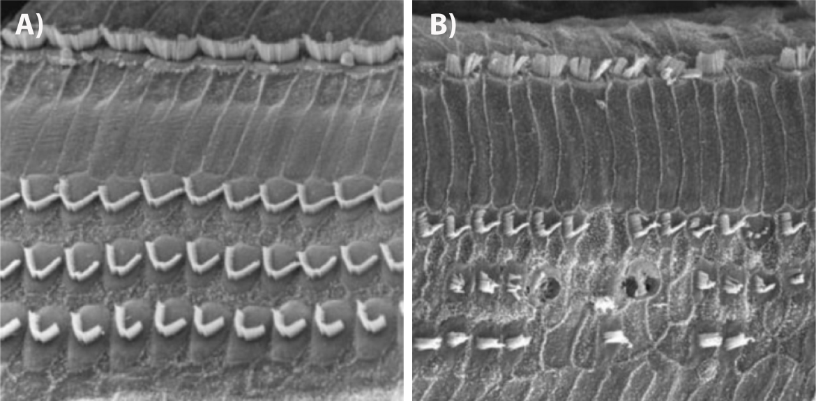 Les mécanismes physiopathologiques de la presbyacousie – Speechneurolab