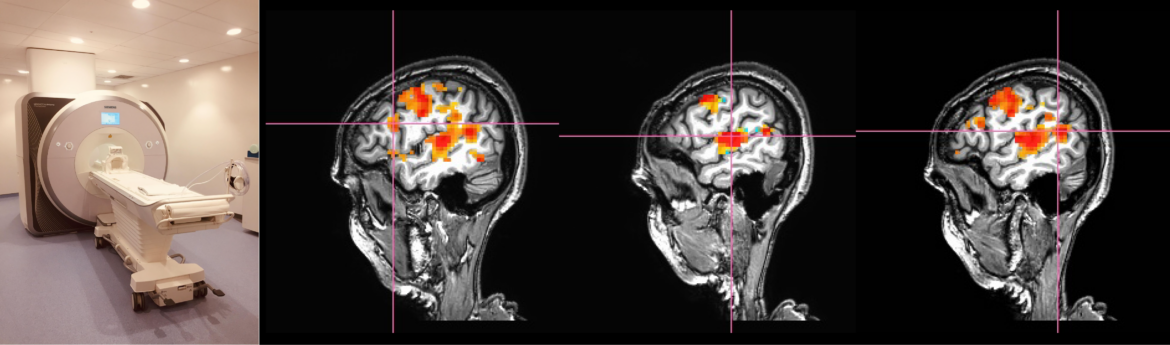Effect of Non-Invasive Brain Stimulation on Speech Perception in Noise ...